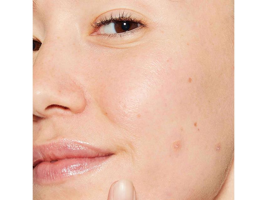 Dermalogica Deep Acne Liquid Patch | LovelySkin