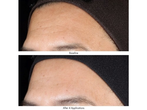 Obagi Medical Revivify Multi-Acid Facial Peel | LovelySkin