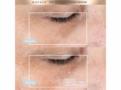 NuFACE FIX Starter Set | LovelySkin