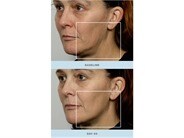 NuFACE Trinity PRO Facial Trainer Kit | LovelySkin