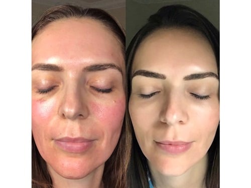 CO2Lift Pro Carboxy Gel Treatment | LovelySkin