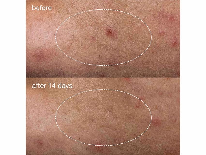 Dermalogica Deep Acne Liquid Patch | LovelySkin